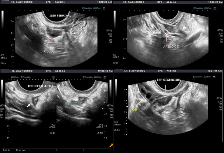 IR Diagnósticos | Endometriose